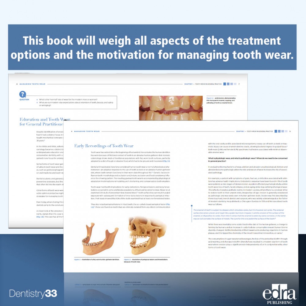 Managing Tooth Wear. A Comprehensive Guide for General Practice ...