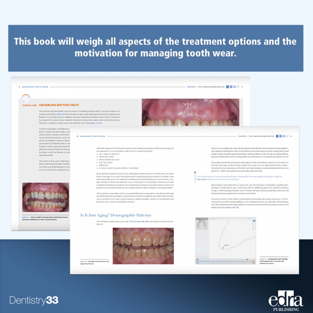 Managing Tooth Wear. A Comprehensive Guide for General Practice ...